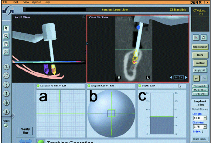 Image-Guided Navigation System for Placing Dental Implants - image ...
